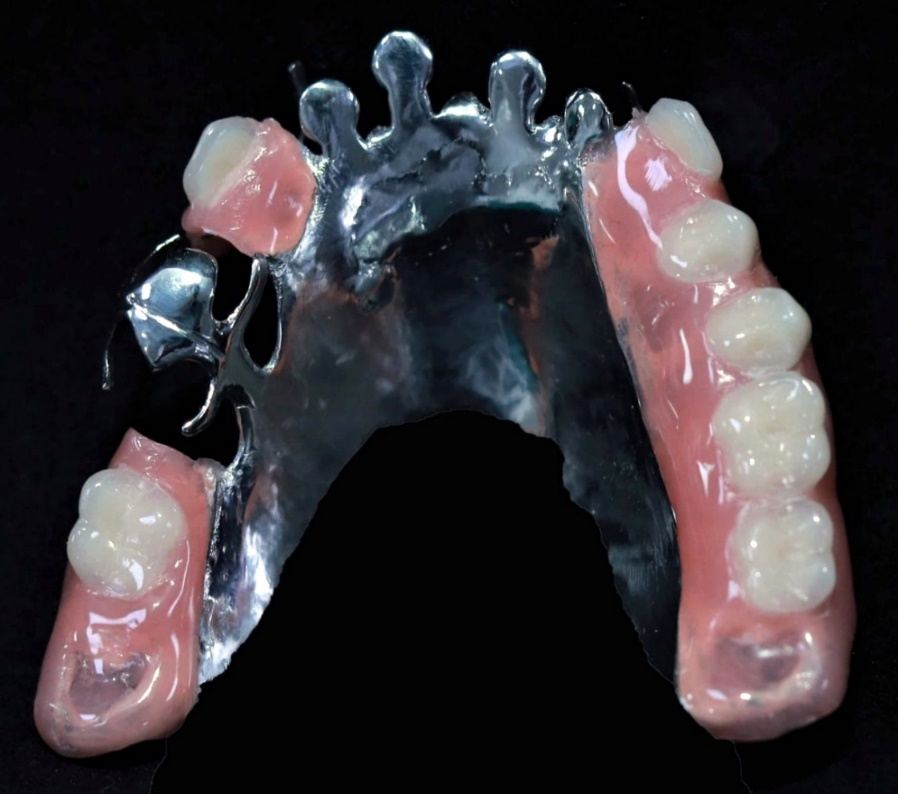 Revolutionizing Rehabilitation: Prosthodontic Management of Distal Extension Using Cobalt ...